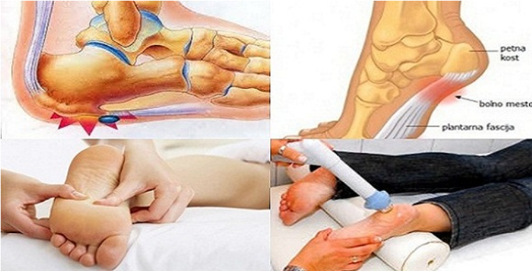 3 Metode simple și rapide, care te scapă de pinteni și de durerile din ...